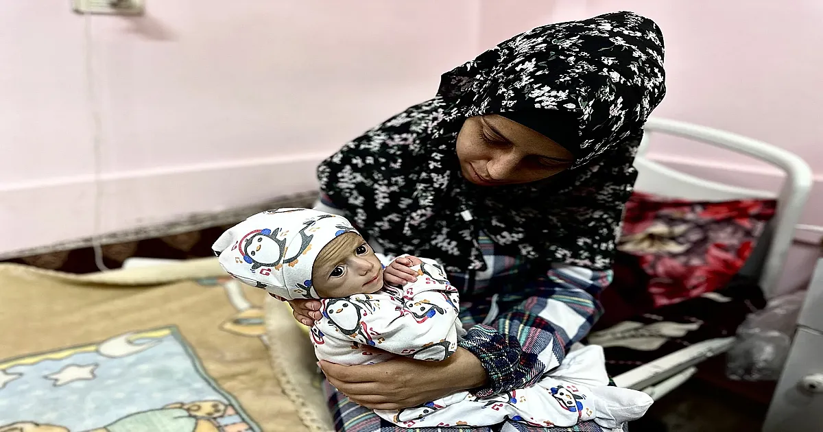 Η έξι μηνών Siwar Ashour γίνεται το τραγικό σύμβολο της πείνας στη Γάζα